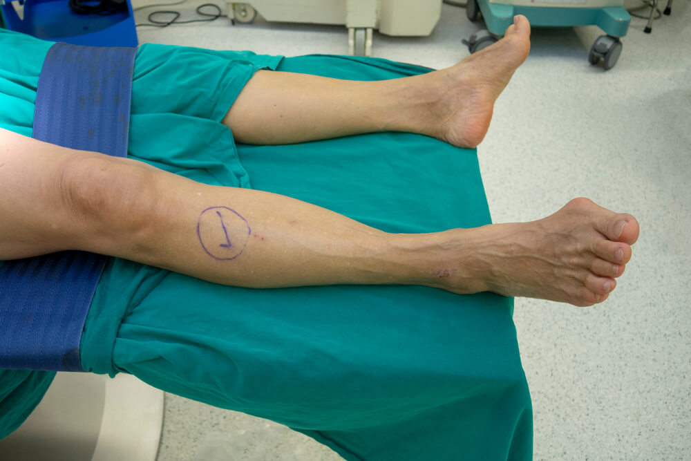 Consequences of Wrong-Site Surgery | Paulson Coletti